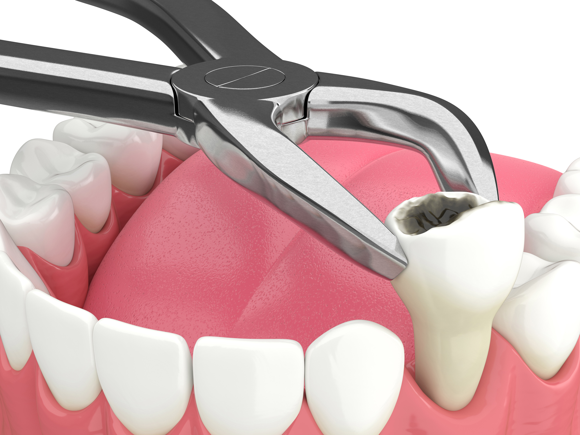 Hobart wisdom tooth extraction - Napol Dental & Implant Clinic